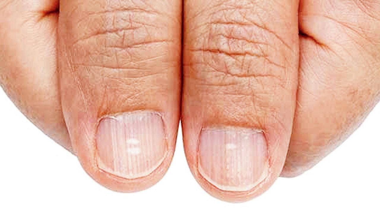 Decoding Nail Health: Signs Your Nails Give About Your Body`s Condition ...