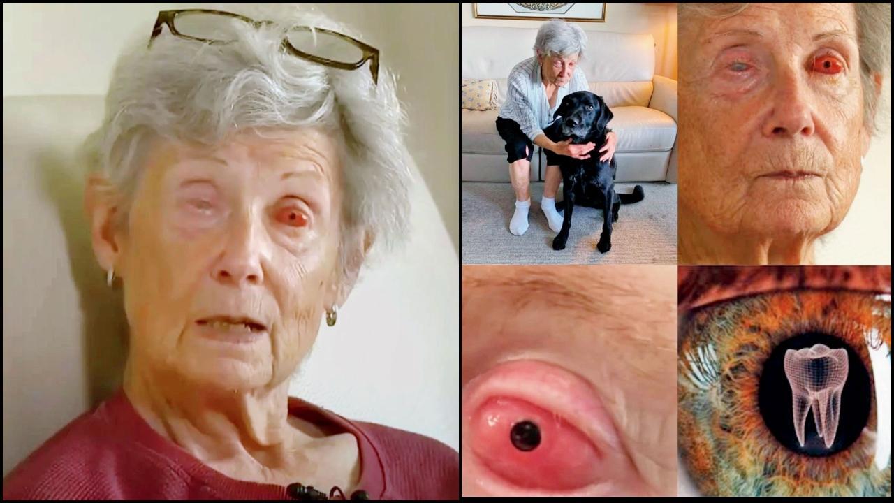 Rare Tooth-in-Eye Surgery Restores Vision to 75-Year-Old Blind Woman ...